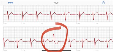 Does This Look Like An Ectopic Beat Rreadmyecg