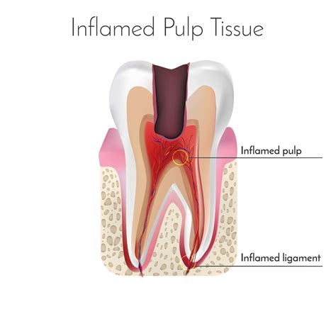 What Is A Root Canal Unraveling The Unknowns In Endodontics