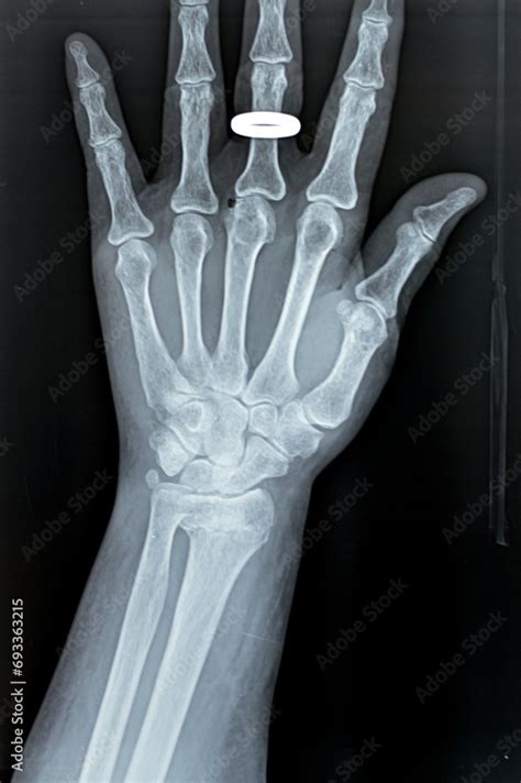 Photo Stock Colles Fracture Of An Old Female A Type Of Fracture Of