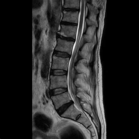 Chestxray8 Activelearning Object Detection Dataset By Cxr