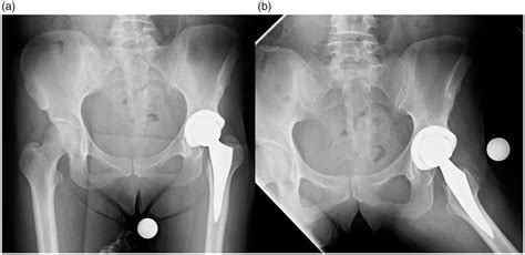 Successful Reconstruction Of Natural Femoral Anteversion Using A Short
