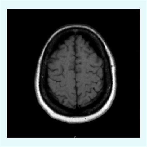 Gradient Recalled Echo Mri Demonstrates Linear Susceptibility In Right Download Scientific