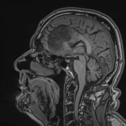 File Astrocytoma Idh Mutant Grade Radiopaedia Sagittal Jpeg Nc Commons