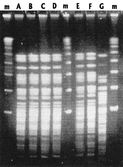 Ochrobactrum Intermedium Infection After Liver Transplantation
