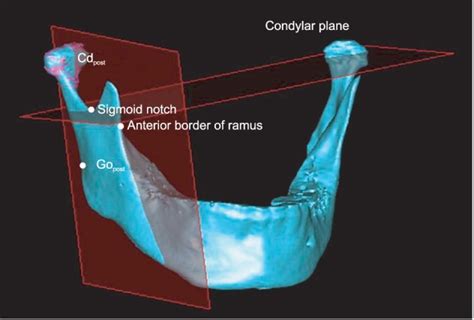 segmentation of the mandibular condyle for condylar measurements see