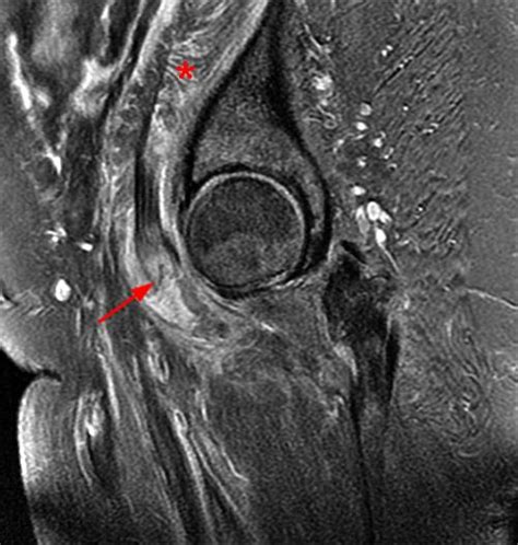 Iliopsoas Bursitis Mri Iliopsoas Muscles Injuries Musculoskeletal