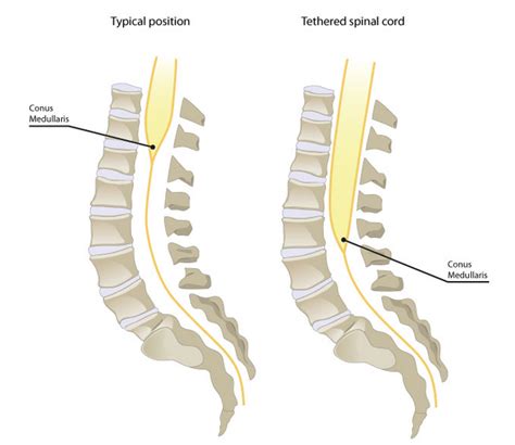 Sacral Dimple In Adults