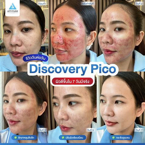 Discovery Pico ใหม่ล่าสุด รักษาได้ทุกปัญหาผิว เทคโนโลยี Picosecond Laser เครื่องแท้จากอิตาลี