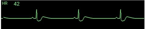 Acls Megacode Scenario 3 Acls Simulator Acls Certification Association Acls Megacode Scenario 3 Acls Simulator Acls Certification Association