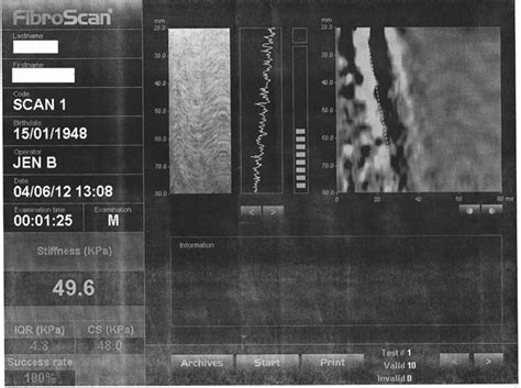 Fibroscan Hep C Bc Legacy
