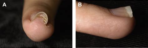 Grafting And Other Reconstructive Options For Nail Deformities Hand