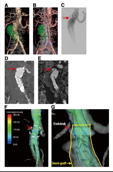 Figure 2 From Hemodynamic Analysis Of Endoleaks After Endovascular