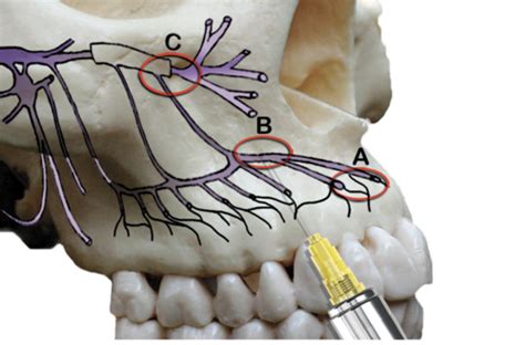 Ch 12 Maxillary Injections Flashcards Quizlet