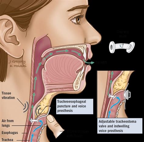 Omar Bani Mustafa On Linkedin Tracheoesophageal Puncture Tep With Prosthesis This Procedure And…