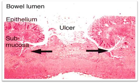 Flask Shaped Ulcer Of Invasive Intestinal Amebiasis Hematoxylineosin Download Scientific