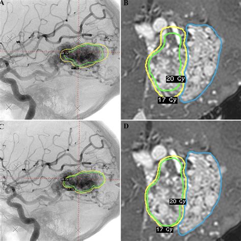 Volume Staged Stereotactic Radiosurgery Neurosurgery Education