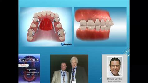 Space Analysis In Orthodontics Youtube