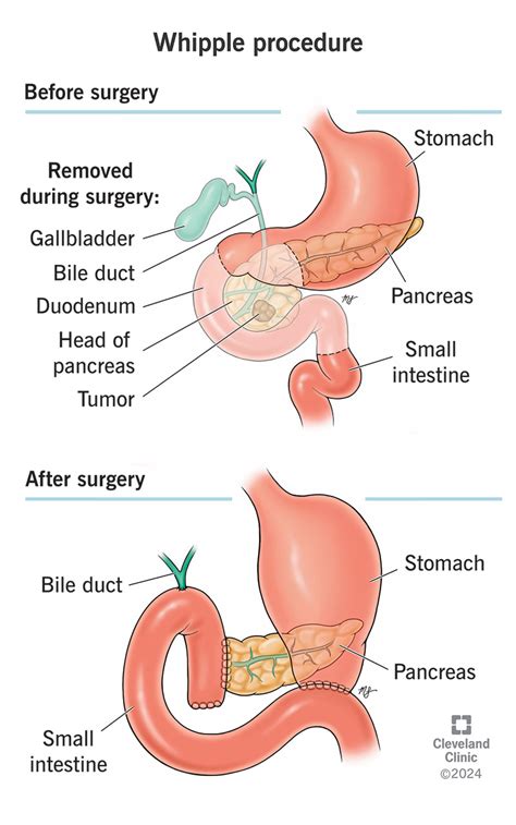 Whipple Procedure Anatomy Pancreaticoduodenectomy Whipple Procedure