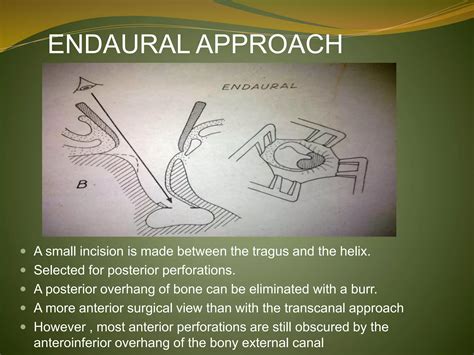 Tympanoplasty Indications Types Anesthesia Surgical Procedure Ppt