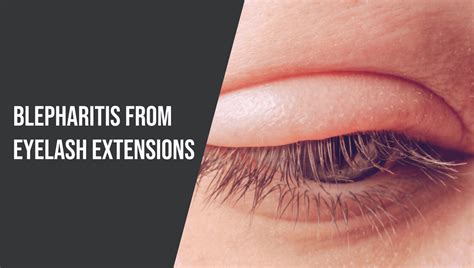 Blepharitis From Eyelash Extensions The Lash Professional