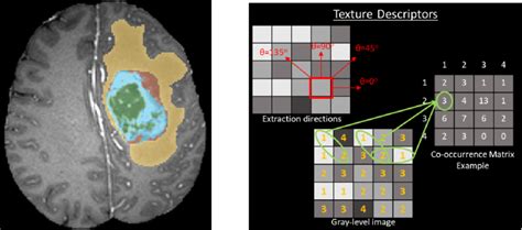 Figure 3 From Identifying The Best Machine Learning Algorithms For Brain Tumor Segmentation