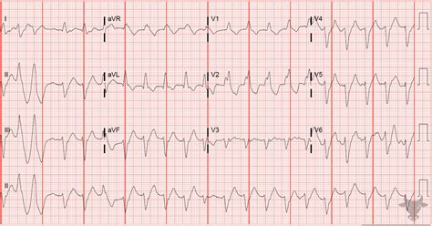 Bifascicular Block Ecg Stampede