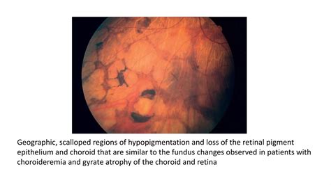 Hereditary Choroidal Diseases Pptx