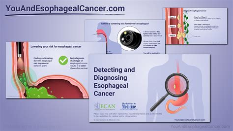 Slide Show Detecting And Diagnosing Esophageal Cancer