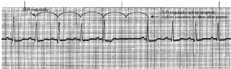 Sinus Arrhythmias Thoracic Key