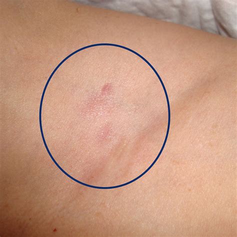 Small Erythematous Left Supraclavicular Atrophic Plaque Download