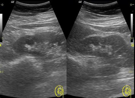 Renal Cyst Ultrasound