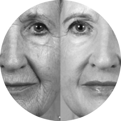 Dermaroller Before And After Results Dermaroller Sa®