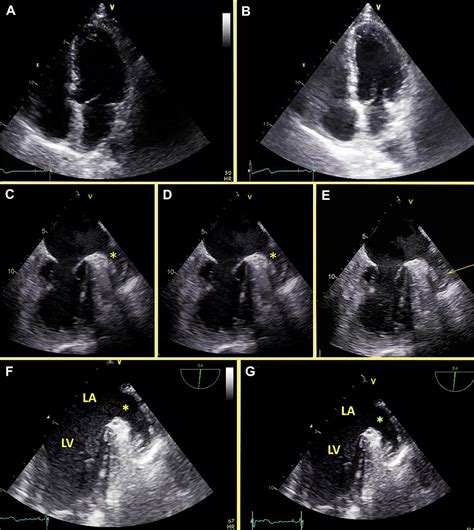 Frontiers Pitfalls Of Echocardiographic Image Perception How To Overcome Them