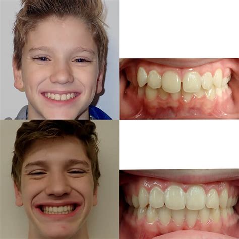 Deep Bite Invisalign