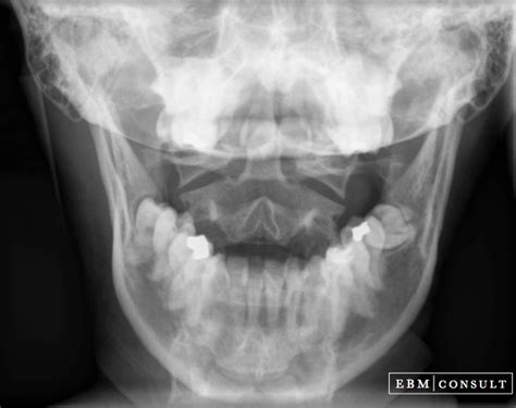 Open Mouth Odontoid Radiograph Xray X Ray Pediatric Dentistry
