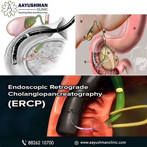 Aayushman Clinic On Linkedin Ercp Gallbladder Endoscope