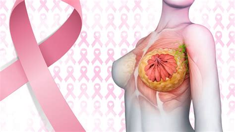 Día Mundial Del Cáncer De Mama Cuáles Son Los Síntomas Y Cómo