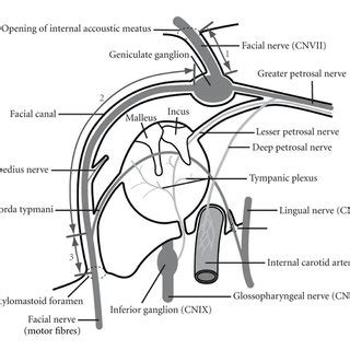 Dissection Of The Whole Chorda Tympani Nerve From Facial Nerve Passing