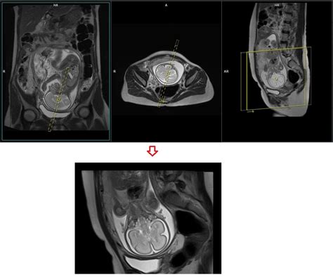 Fetal Brain Mri Fetal Brain Scan Protocol And Planning