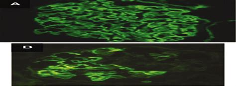 X Inactivation Female Mosaicism And Sex Differences In Ren