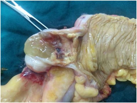 Macroscopic View Of Mucocele Appendix With Mucous As Content
