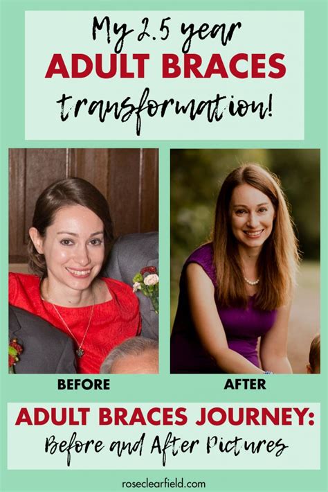 My Adult Braces Transformation • Rose Clearfield