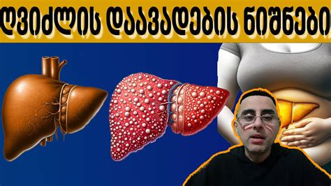 ღვიძლის დაავადების 5 ნიშანი და მკურნალობა ღვიძლის გაცხიმოვნება Youtube