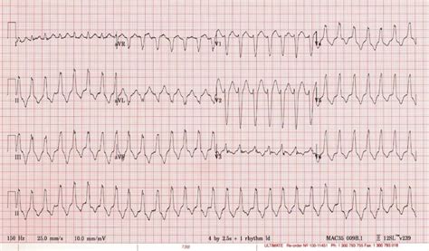 Figure 031 2 2864 Ventricular Arrhythmia A Monomorphic Ventricular Tachycardia B Ventricular