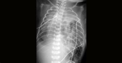 Identify Abnormality From This Neonatal Radiograph