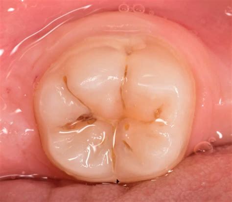 Direct Posterior Composite Myzerodonto