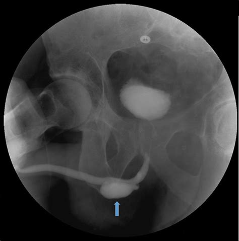 Urethral Diverticulum Mri