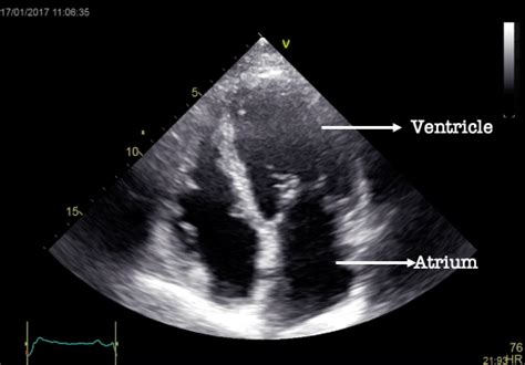 16 Example Of A 2D Echocardiography Image Obtained From A Healthy Subject Download