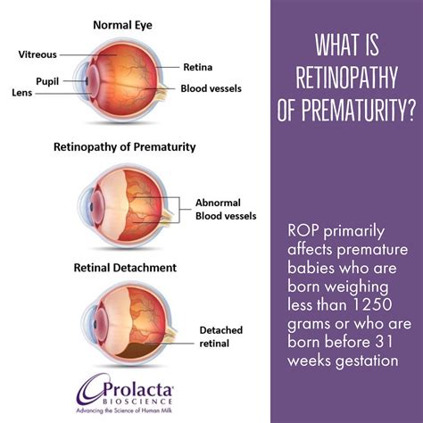 Puffy Eyes Preemie At Ryder Sturdee Blog
