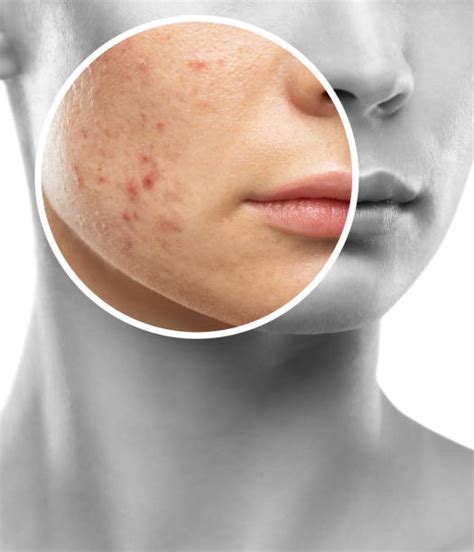 20 Pyoderma Disease Foto Stok Potret And Gambar Bebas Royalti Istock